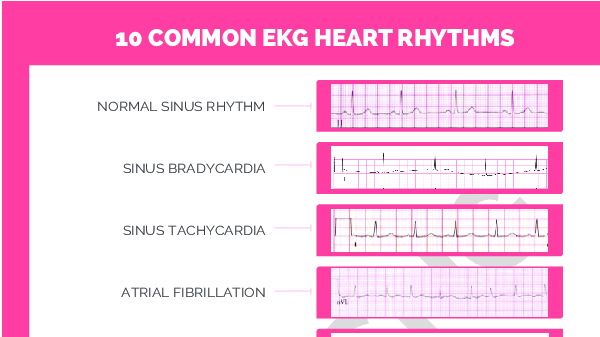 10 Common EKG Heart Rhythms | NURSING.com