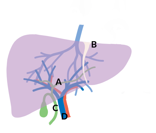 10 Free 03.04 Nursing Care and Pathophysiology for Cirrhosis (Liver ...
